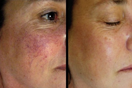 Broken Capillaries Treatment –– by Advanced Dermatology