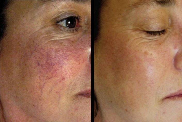 Broken Capillaries Treatment –– by Advanced Dermatology