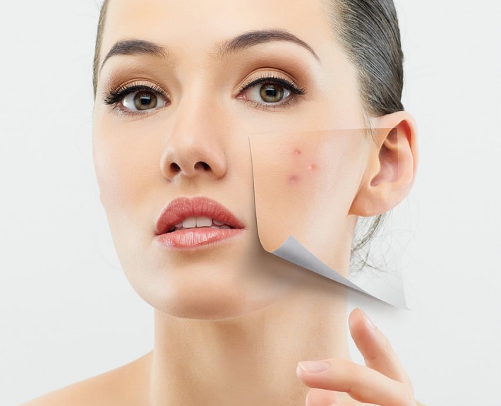 Busting Acne Myths — Advanced Dermatology
