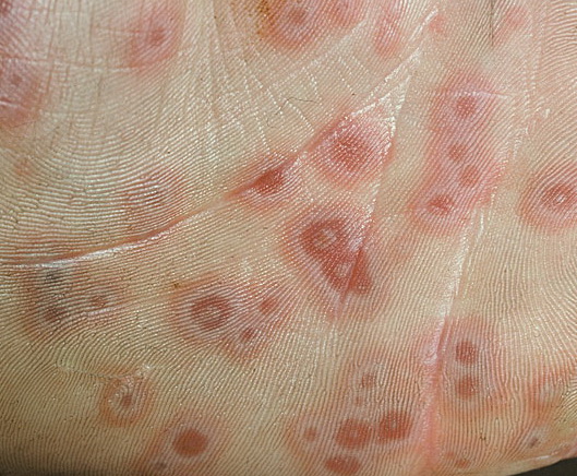 Erythema multiforme store