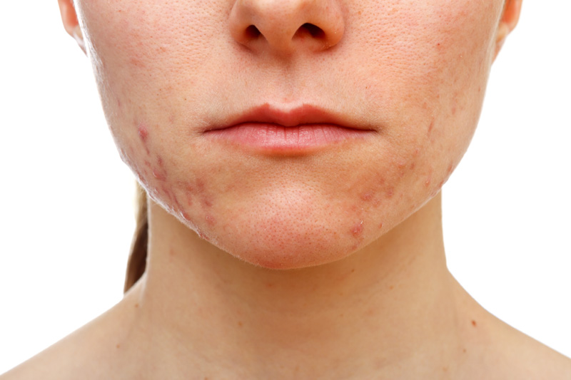 Jawline Acne Advanced Dermatology Jawline Acne Advanced Dermatology
