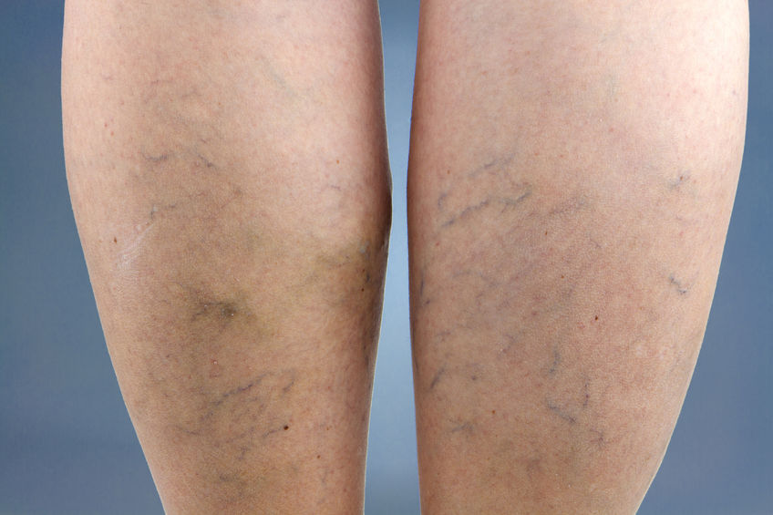 Thread Veins – Advanced Dermatology