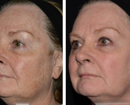 LaseMD Ultra — Advanced Dermatology